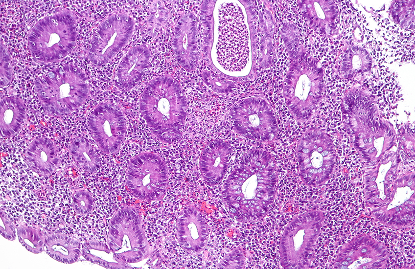 New Molecules Point the Way Toward Treating Crohn’s Disease | Harvard ...