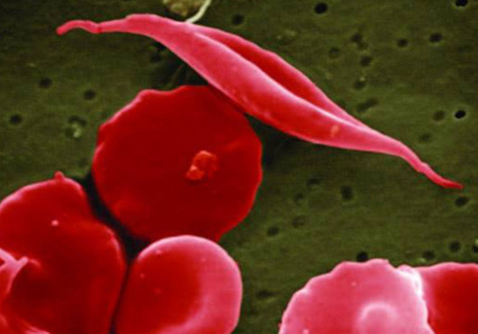 New Tool Helps Uncover Rare Genetic Mutations in Common Diseases ...