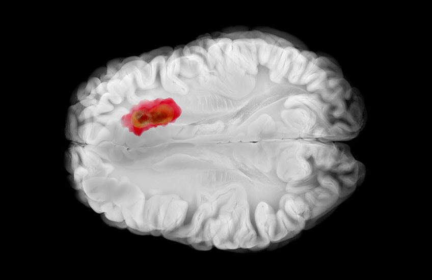 Early Clinical Trial Results Show Promise for Glioblastoma ...