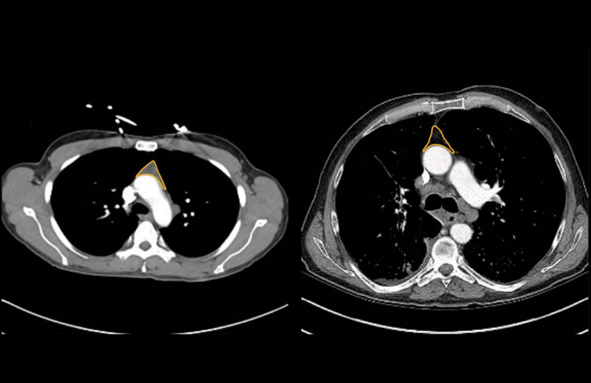 Thymus May Be Critical for Longevity and Cancer Immunotherapy Response ...