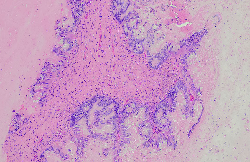 Experimental Drug Doubles Median Survival in Patients With Metastatic ...