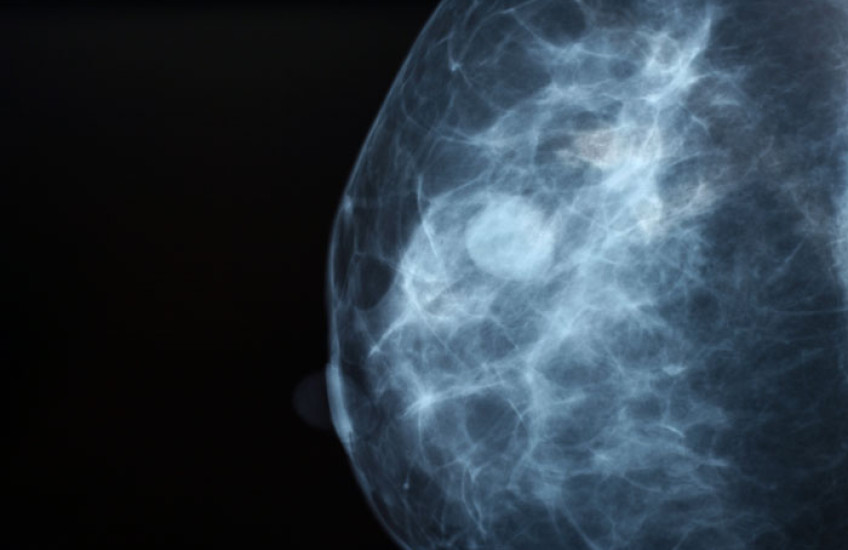 The "Angelina Jolie" Effect | Harvard Medical School
