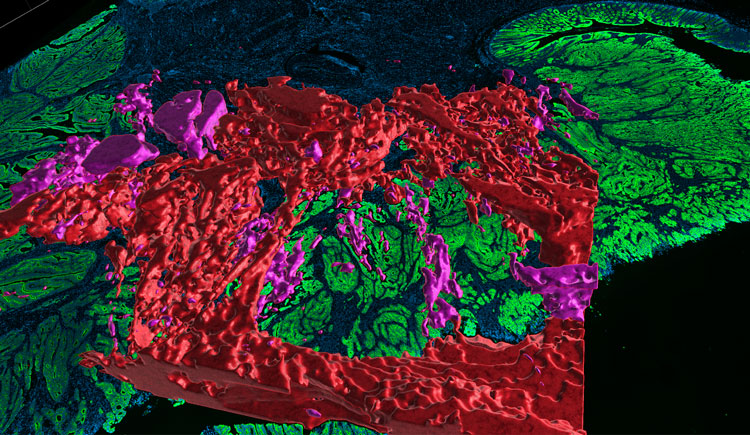 Mapping Colorectal Cancer to Uncover Dynamics | Mirage News