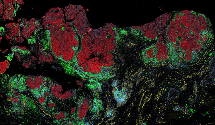 Spatial maps of melanoma reveal how individual cells interact as cancer ...