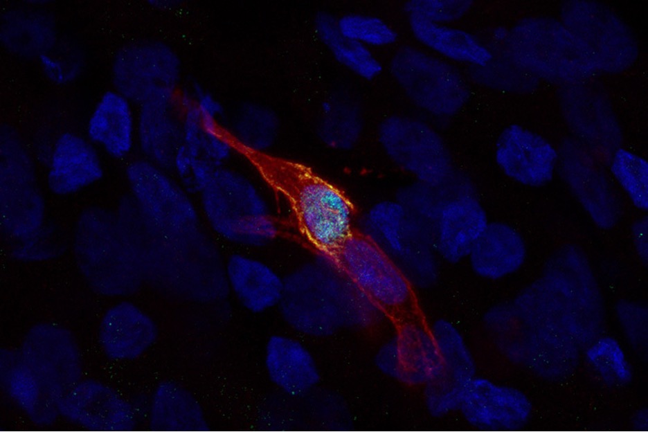 Research Advances Cell/Gene Therapy for Cystic Fibrosis | Mirage News