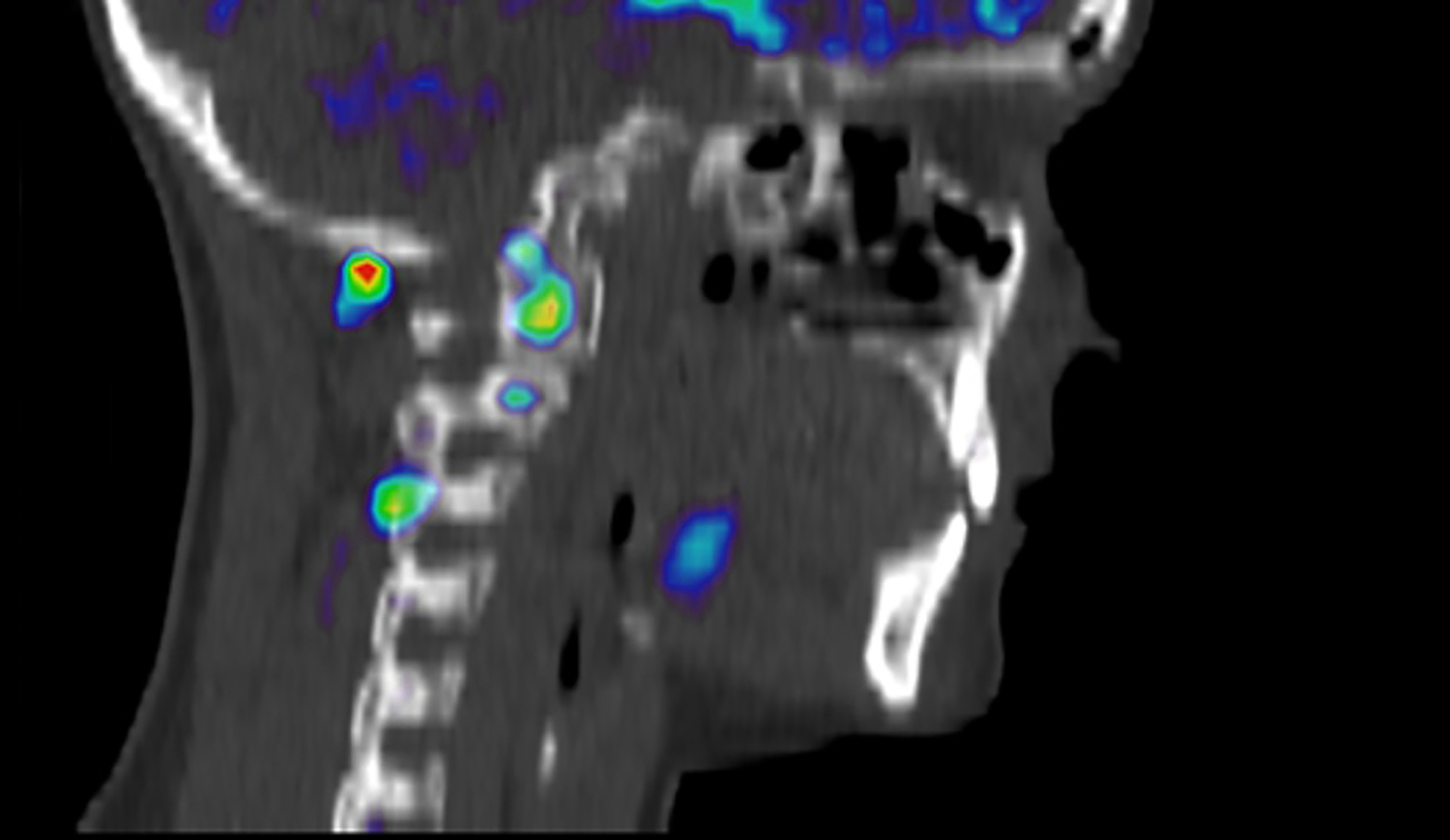 Injuries from whiplash made visible with new scanning approach | Mirage ...